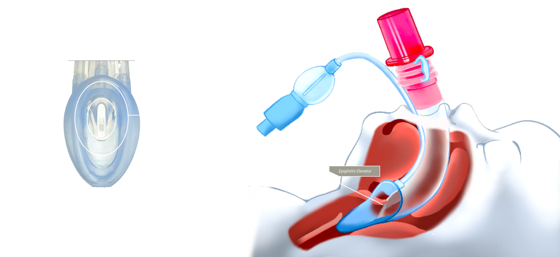 Air-Q3 Neonatal Sizes | AirLife